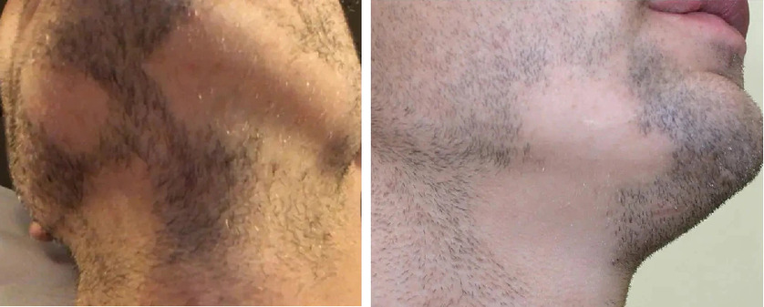 7 Common Causes Of Patchy Beard Growth