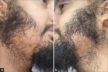 7 Common Causes Of Patchy Beard Growth